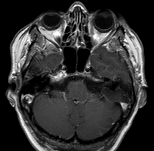 Colesteatoma della rocca petrosa - ORL Modena