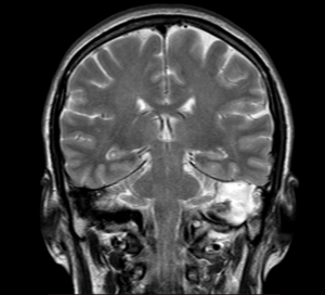 Colesteatoma della rocca petrosa - ORL Modena