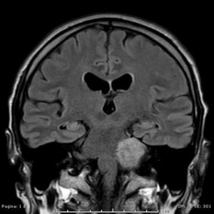 Neurinoma del nervo acustico - ORL Modena