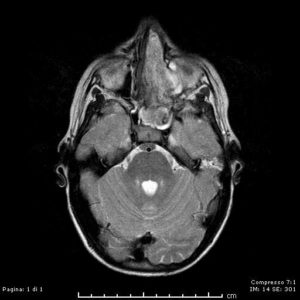 Angiofibroma del rinofaringe - ORL Modena